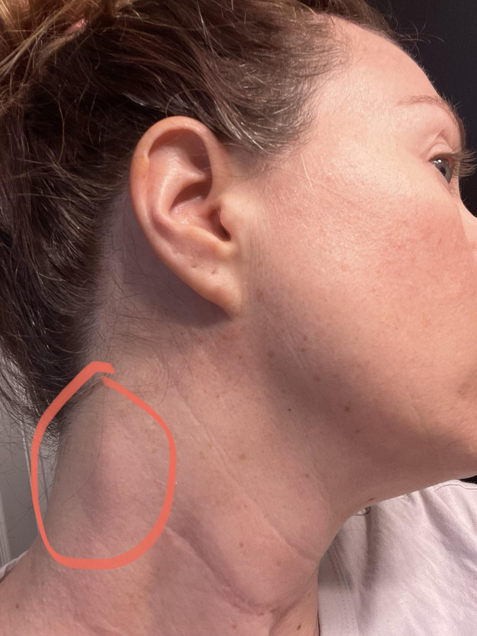 Swollen Lymph Nodes in Neck, One Side - Causes, Symptoms, Treatment,